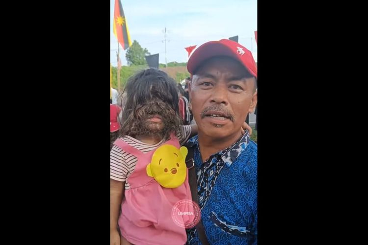 GoRiau - Adik Missclyen, Bayi 'Manusia Serigala' yang Disebut Raja ...