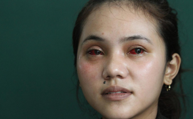 GoRiau - Korban Tragedi Kanjuruhan, Mata Cahayu dan Kevia Masih Merah ...